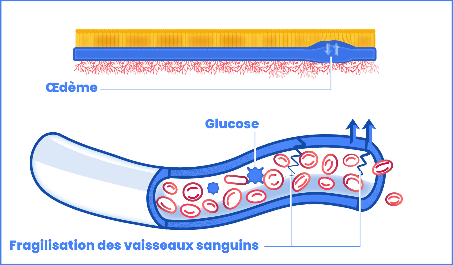 Hyperglycémie : cause de la rétinopathie diabétique et de l'OMD